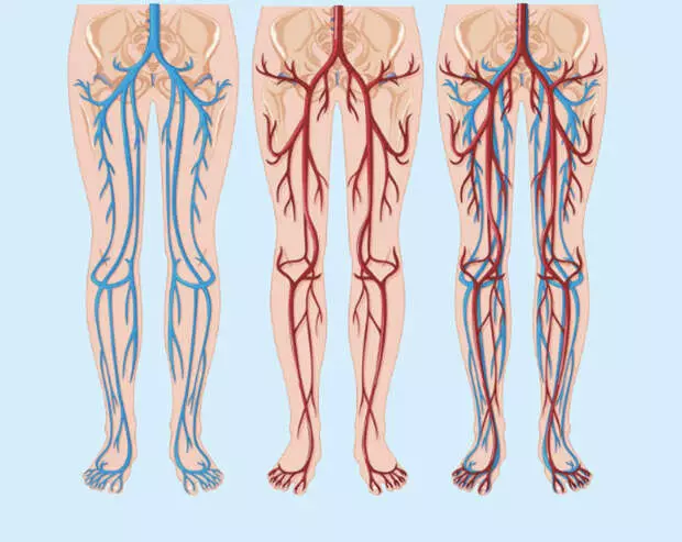 Veins varicose: mmega ahụ dị mfe maka nkwụsị ọbara