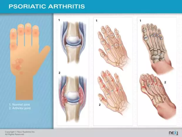 Łuszczycowe zapalenie stawów: 5 głównych typów