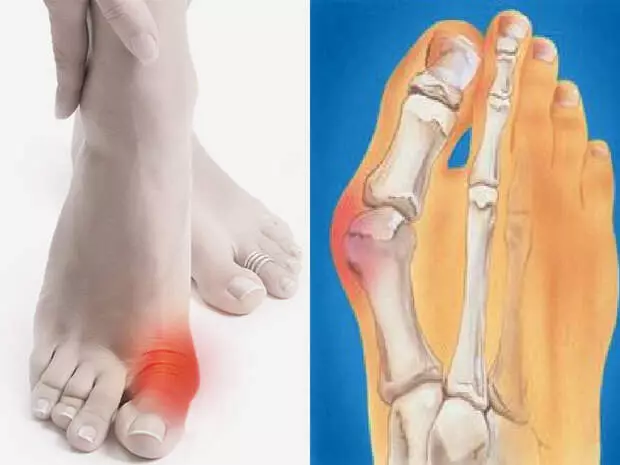 Keseimbangan kaki: teknik osteopathic yang kuat dari tulang di kaki