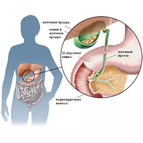 Risiko gallstones ing obesitas lan bobot mundhut