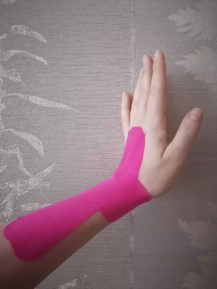 Példa a szalagozásra kéztőalagút szindróma esetén - carpal tunnel szindróma