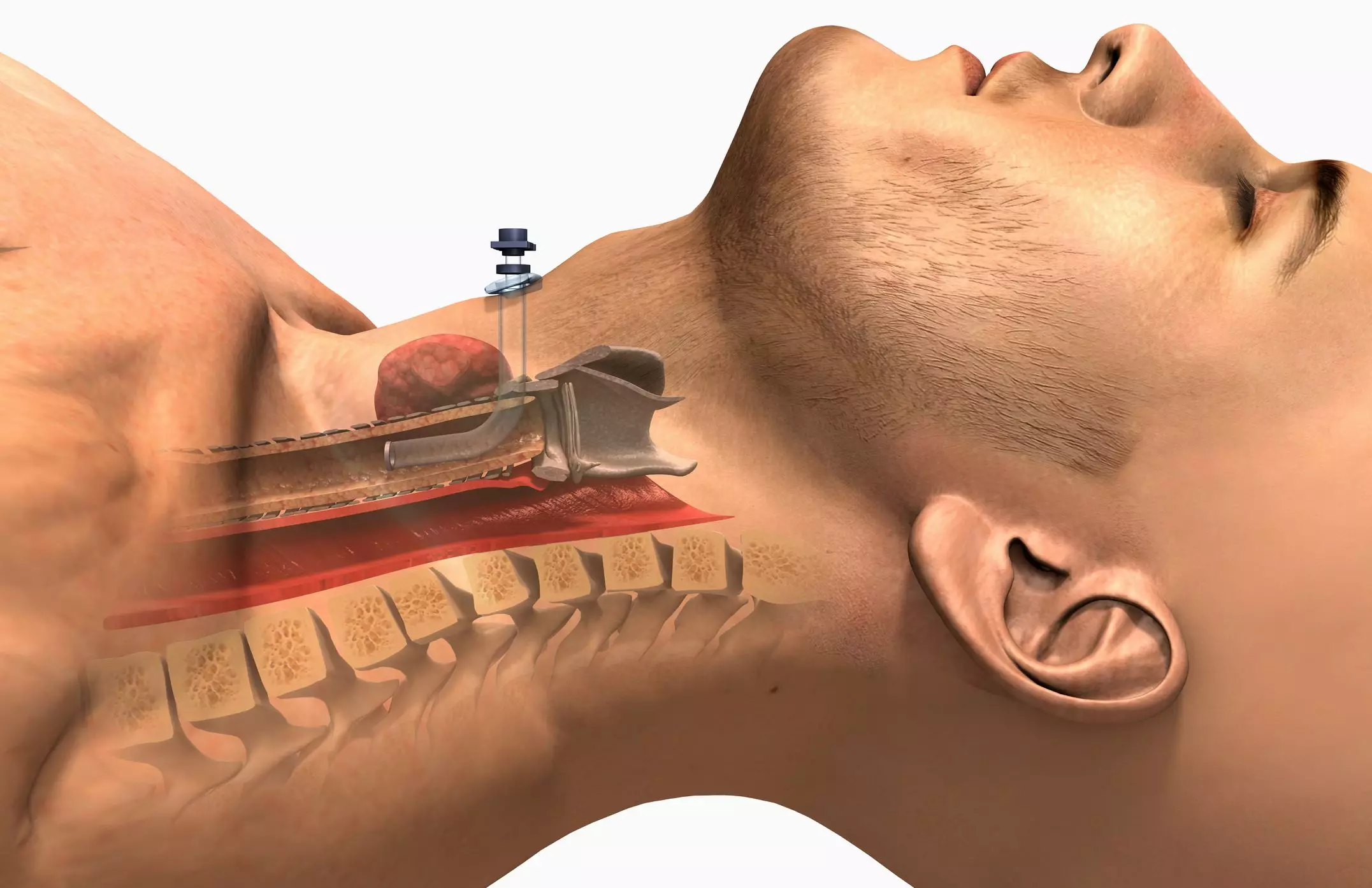 I-tracheostomy