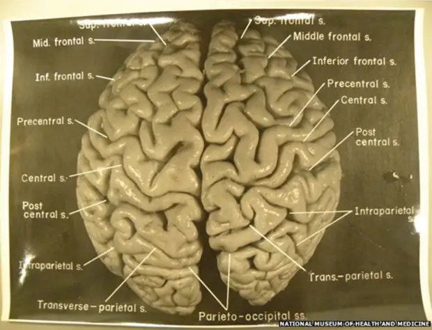 Harvey បានបែងចែកខួរក្បាលរបស់ Einstein ជា 240 បំណែក។