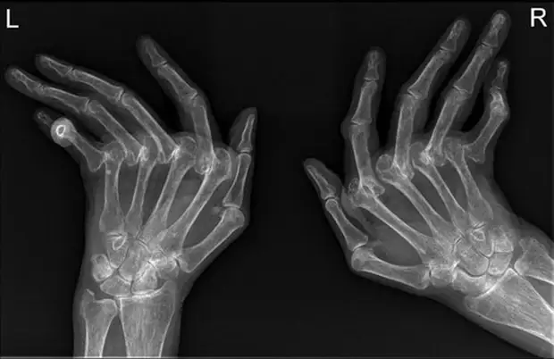 Arthritis Rheumatoid: o le ṣe itọju, ko le ṣe iwosan. Ṣugbọn iyẹn yoo yipada laipẹ