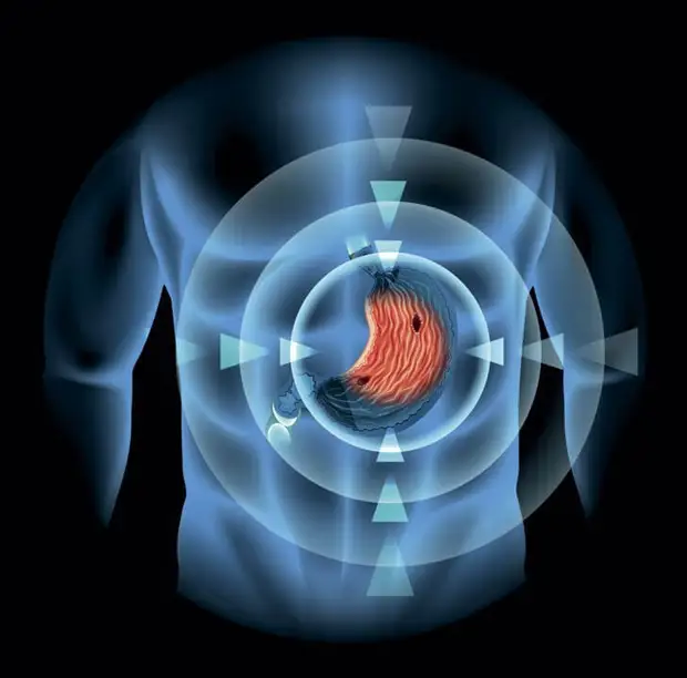 Ulcer de stomac: Întregul organism trebuie tratat!