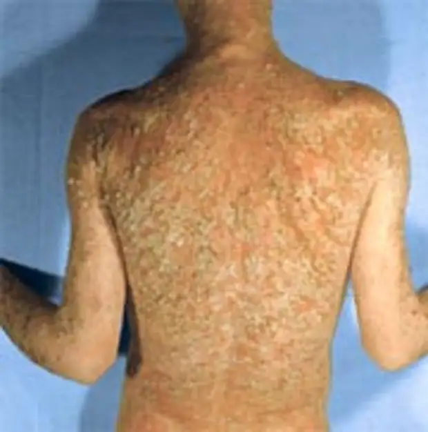 Mmasị maka akpụkpọ ahụ: eczema, psoriasis, dermatitis