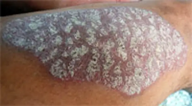 Mmasị maka akpụkpọ ahụ: eczema, psoriasis, dermatitis