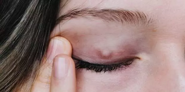 Chalazion: wéi een e Klump op der Auge lass gëtt, déi d'Liewen vergëft