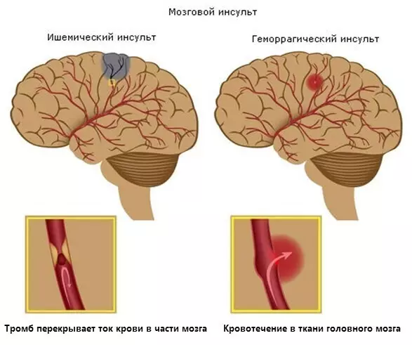 Faktory vyvolávajúce vývoj ochorenia