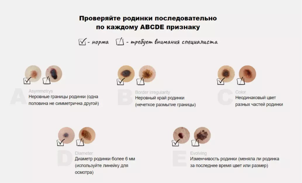 5 отговора на важни въпроси за бенките по тялото ни