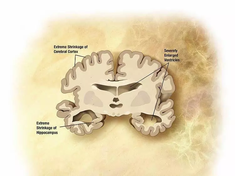 Utshintsho lwe-neurodeergenerative kwingqondo kwisifo sika-Alzheimer