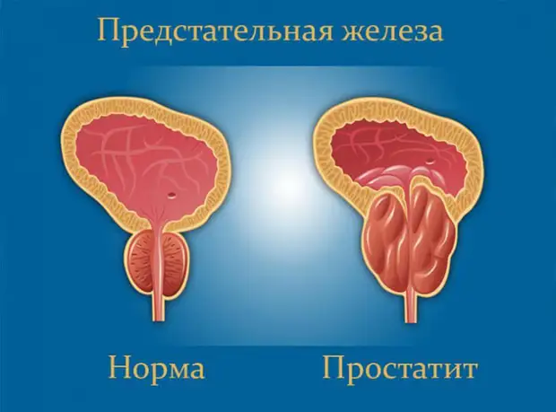 I-PROSTATE: 10 Ukuzivocavoca Okuzosiza