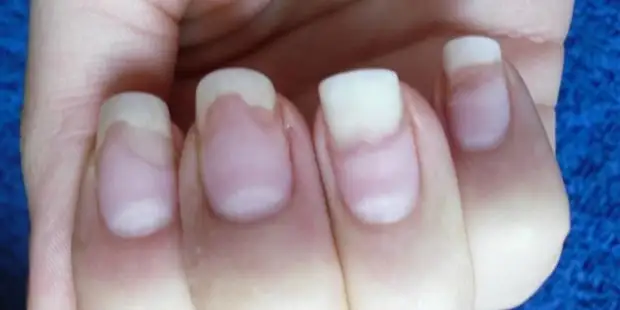 ناخنوں سے صحت کی حالت کا تعین کیسے کریں (11 نشانیاں)