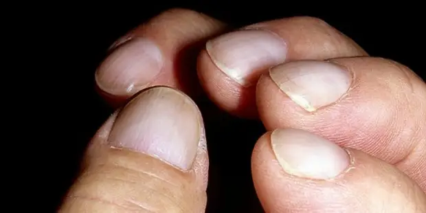 Jak określić stan zdrowia za pomocą paznokci (11 znaków)