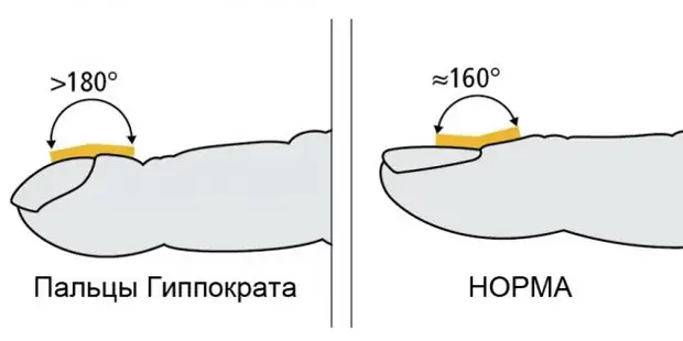 тырмактары менен ден соолук абалын кантип аныктоого болот (11 белги)
