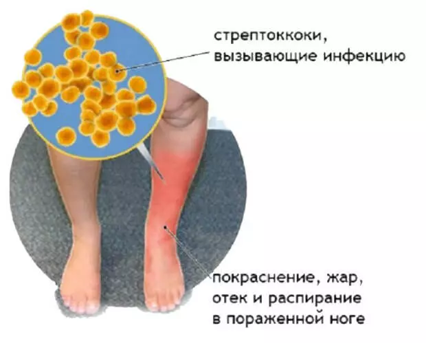 Эрисипел бол залуу эрэгтэйчүүд болон өндөр настай эмэгтэйчүүдэд тохиолддог өвчин юм