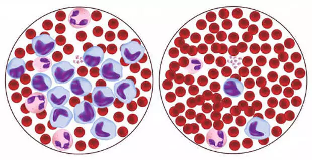 Kwa nini lymphocyte ni chini na nini cha kufanya kuhusu hilo