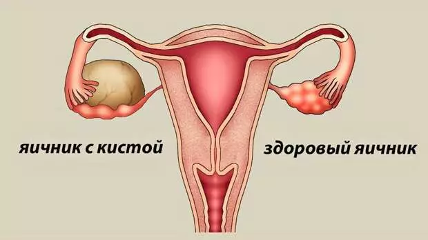 Ovariálna cysta: príznaky a liečba