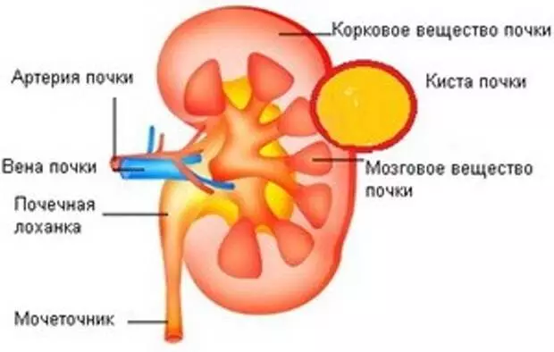 Cyst duáin