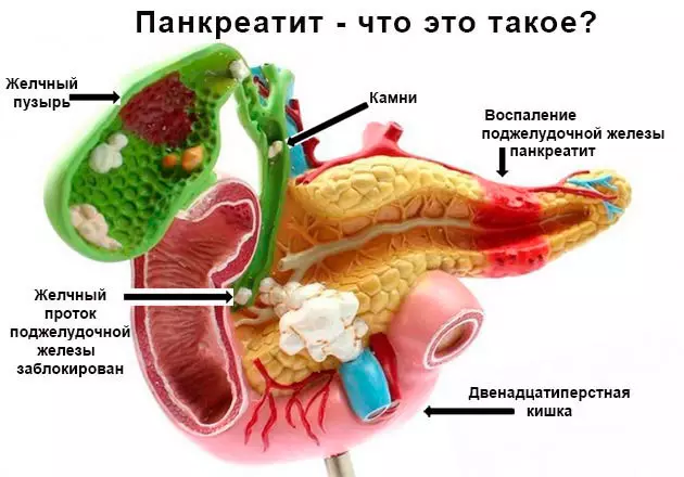 Zomwe zimafunikira kudziwa za pancreatitis pachimake