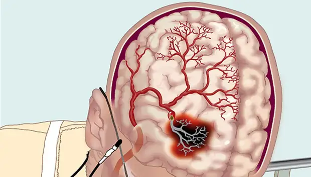 Hotuna akan buƙata Cerebrovascular accident (stroke)