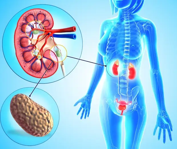 causas da doença renal