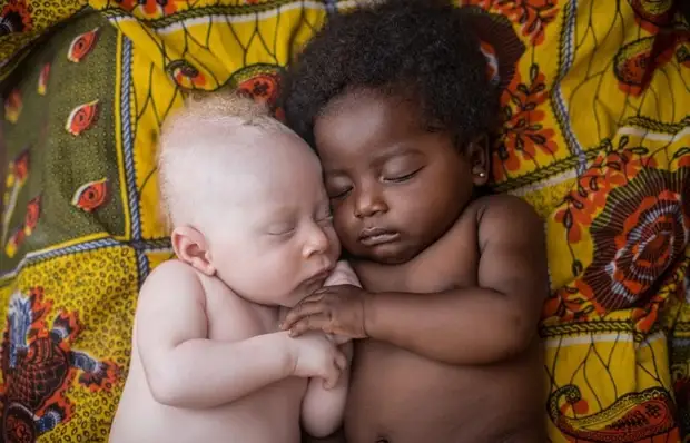 Wéi Albinos vu verschiddenen Nationalitéiten a Rennen ausgesinn