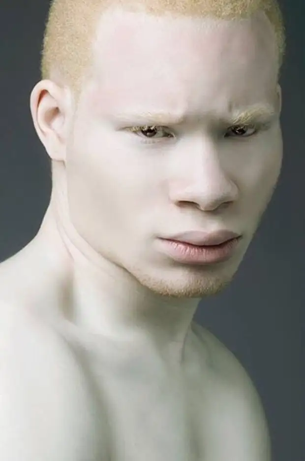 albinos ຂອງຊາດແລະເຊື້ອຊາດທີ່ແຕກຕ່າງກັນມີລັກສະນະແນວໃດ