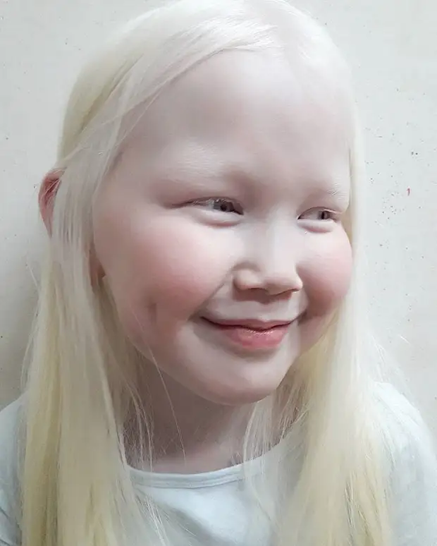 À quoi ressemblent les albinos de différentes nationalités et races