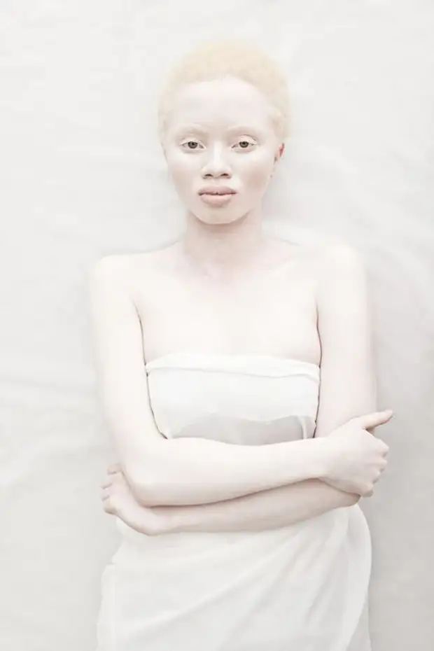 Ano ang hitsura ng mga albino ng iba't ibang nasyonalidad at lahi