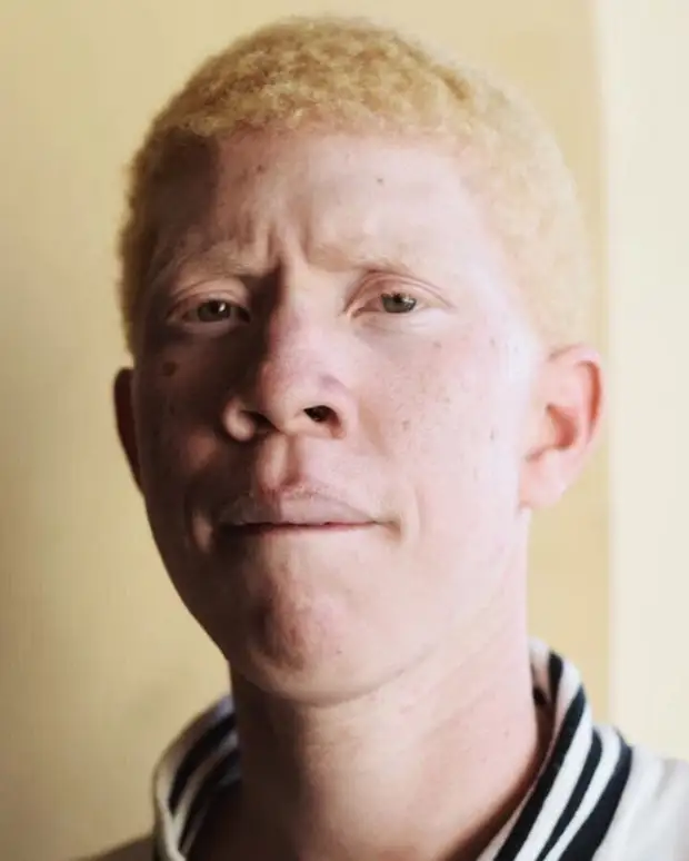 À quoi ressemblent les albinos de différentes nationalités et races