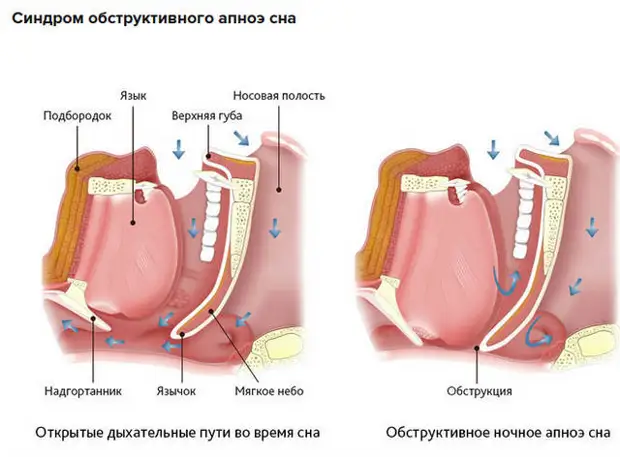 apnea6 (640x472، 136Kb)