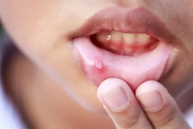 15. Zizka - in pimple op 'e lippen en tonge fan Rusa, leuke feiten, medisinen, nammen, folk medisinen, Russyske folkssykten