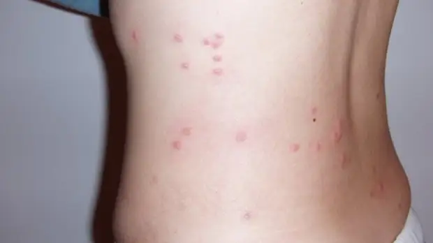 3. Scabies - scabies, dit is ûnophâldende jeuk troch it hiele lichem fan Rusa, leuke feiten, medisinen, nammen, folksmedisyn, Russyske folkssykten