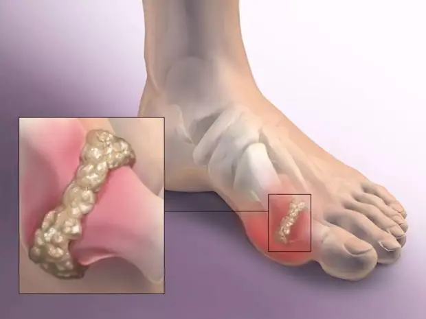 4. Foot trap of keninklike sykte - in chronike sykte feroarsake troch metabolic steurnissen mei in tanimming fan de ynhâld fan urinesoer yn it bloed en de ôfsetting fan syn sâlten yn 'e weefsels en organen fan Rus, leuke feiten, medisinen, nammen, folk medisinen , Russyske folkssykten