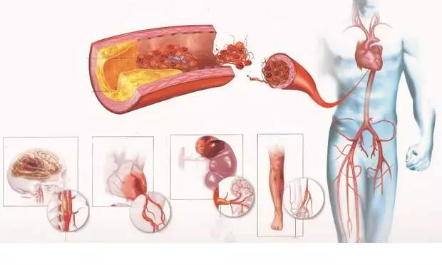 Atherosclerosis - "seoa" sa mehleng ea rona