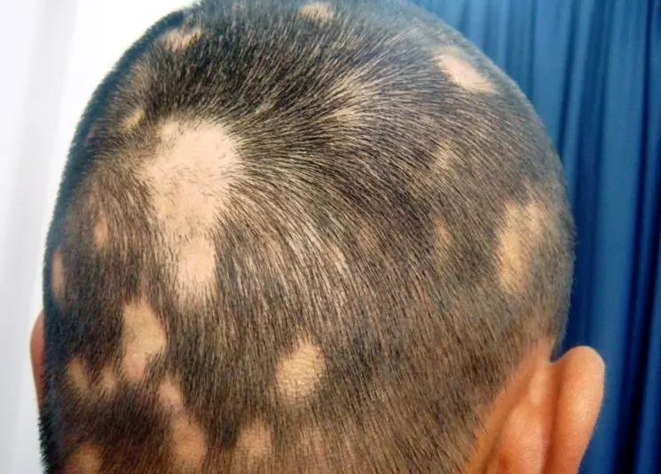 Alopecia areata