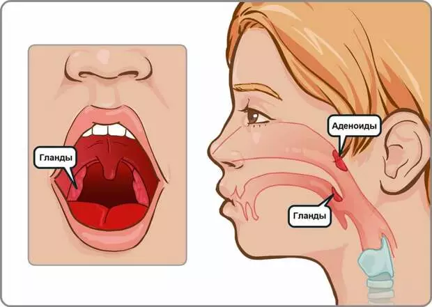 Aký je rozdiel medzi adenoidmi a mandľami a mali by sa odstrániť?