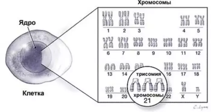 Дауны синдромтой хүмүүс яагаад бие биетэйгээ адилхан байдаг вэ?