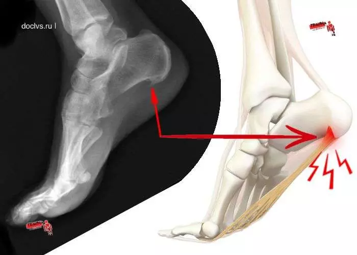 Hielspoor of fasciitis plantaris