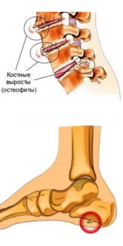 П'яткова шпора або плантарний фасціїт