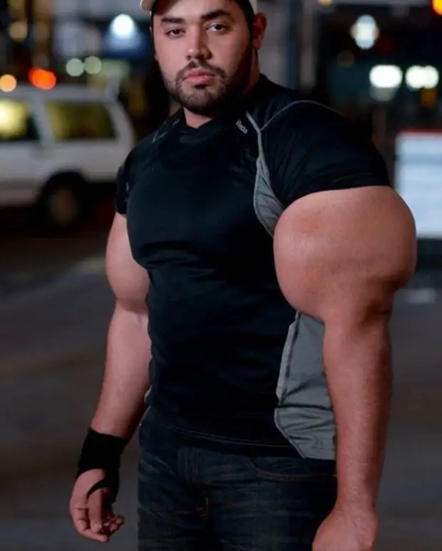 This is what happens when you inject synthol only into the biceps and triceps Synthol, hypertrophy, stop them already, bust, overdone, pseudo-pumping, swayed, synthol