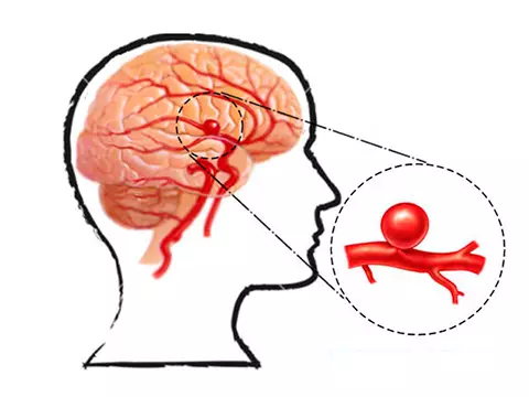 Aneurysm of the cerebral vessels. Early signs