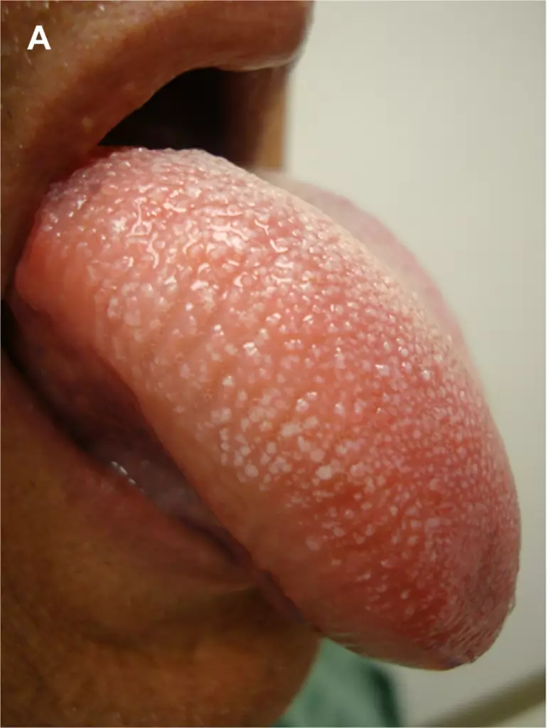 过敏反应，过敏反应的临床表现，舌头血管性水肿，口咽血管性水肿