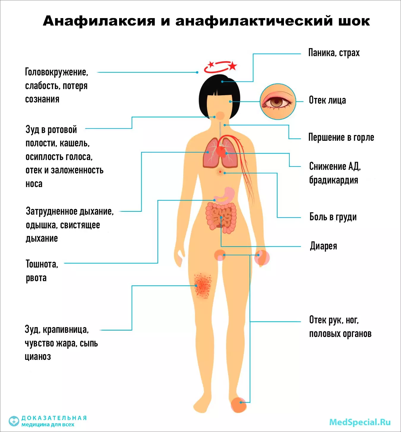 anafilaxia, shock anafiláctico