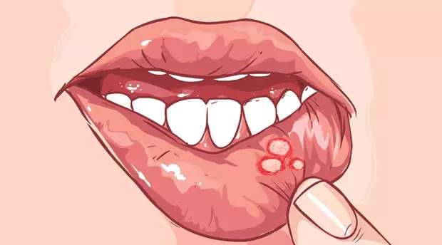 Why does stomatitis appear and how is it treated