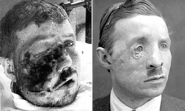 Mga sundalo ng WWI - mga pasyente ng mga unang plastic surgeon