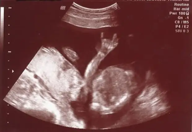 Baby Rocks Ultrasound