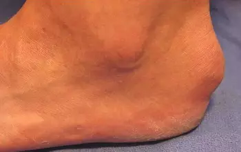 Calcaneal bursitis