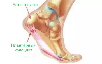 Fasciitis Plantar